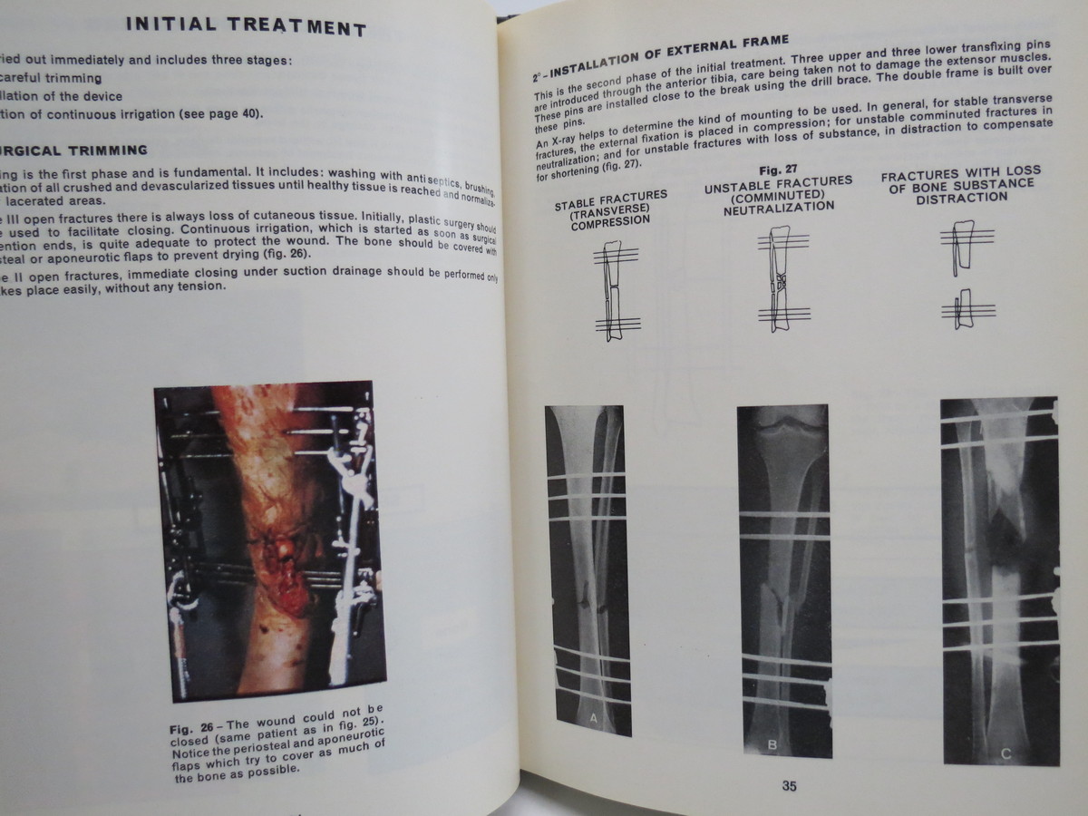 the hoffman's external fixation Techniques, Indications and Results